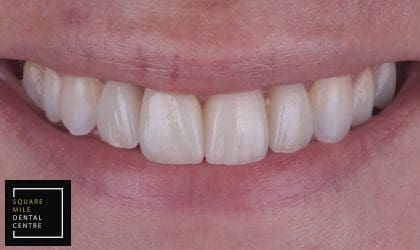 Porcelain Veneers | Square Mile Dental Clinic | London Veneers