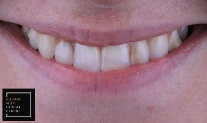Porcelain Veneers | Square Mile Dental Clinic | London Veneers