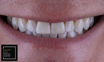 Invisalign | Square Mile Dental Centre | Teeth Straightening London